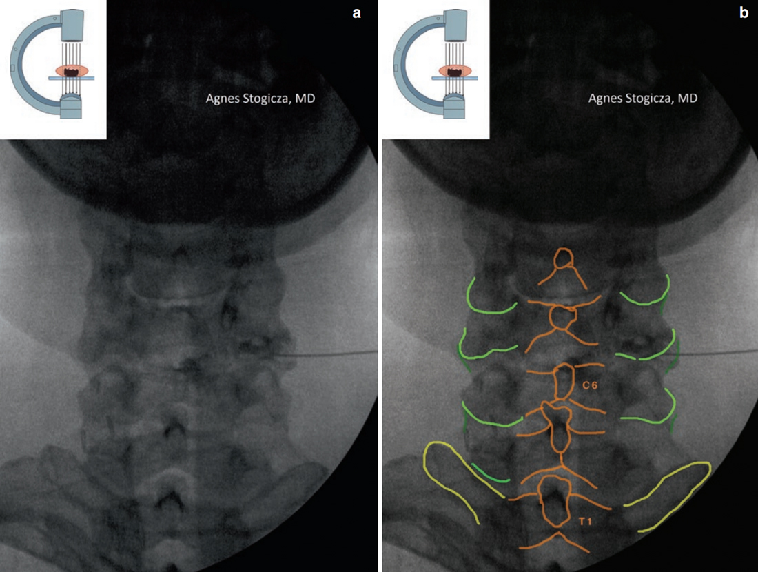 Interventional Pain | PocketEDU